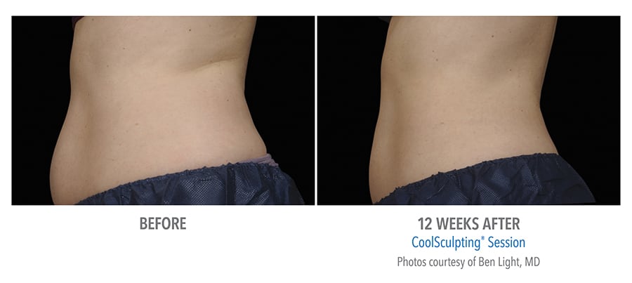 CoolSculpting - Cosmetic Dermatology Center